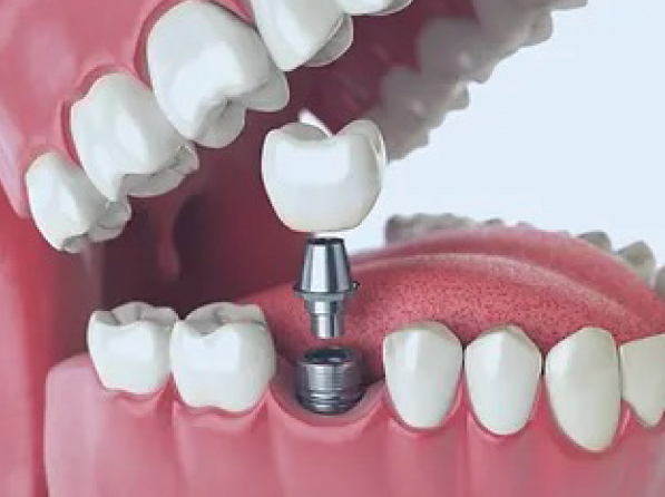 Single Tooth Implant – Mindy Benjamini MD